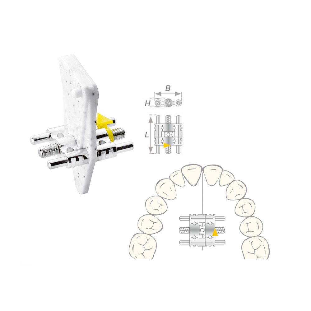 Dehnschraube Vector maxi | Dehnschrauben | KFO | Labor | austro dent ...